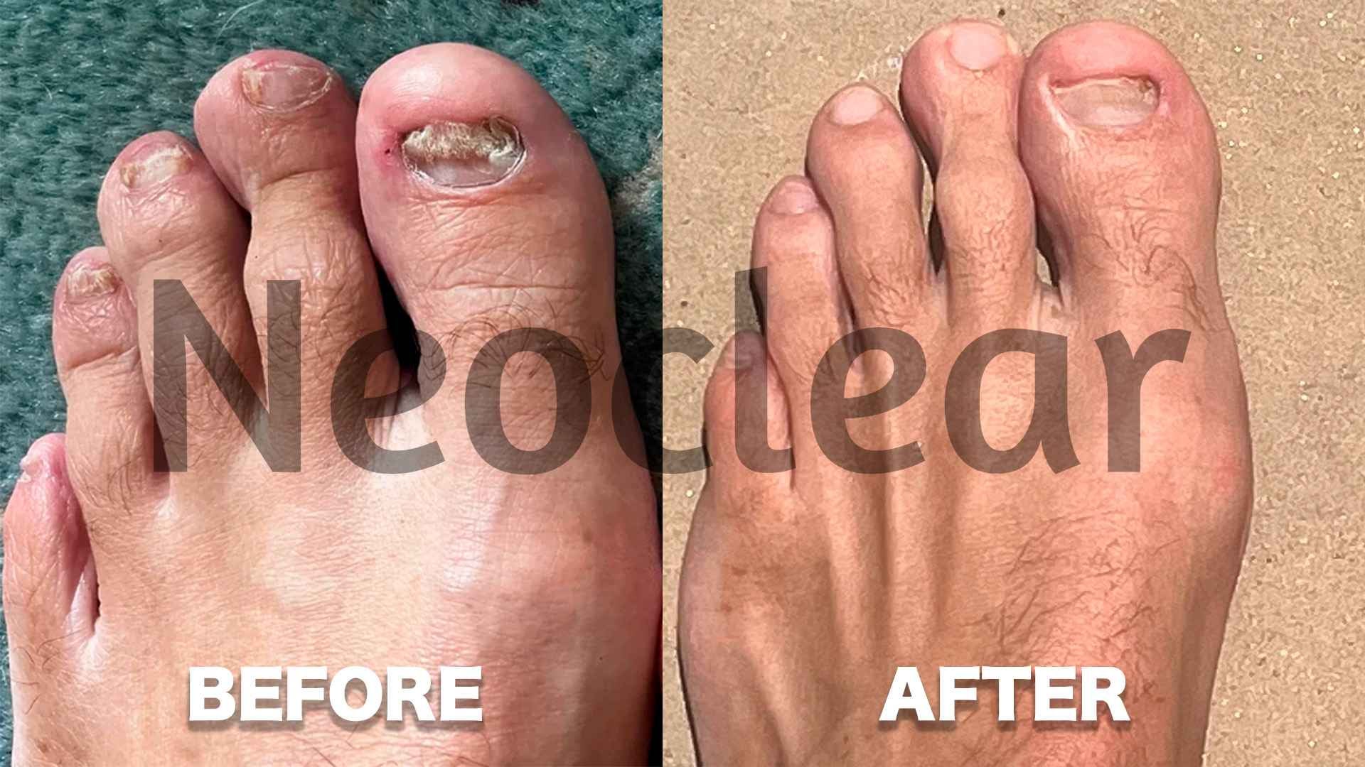 Neoclear Low Level Laser Therapy Device